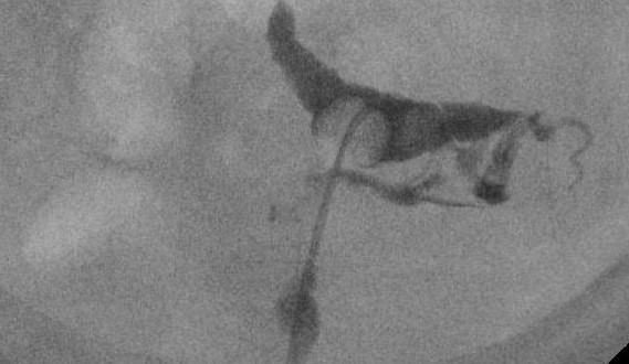 Tubal Patency Tests - NUH Life